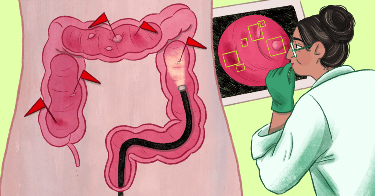 Why Is Getting a Colonoscopy Important? | IrritableBowelSyndrome.net